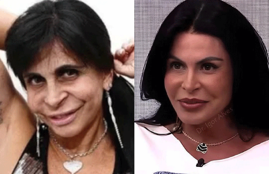 Gretchen surge com 'novo rosto' e rebate críticas; veja antes e depois